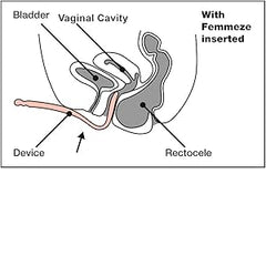 Femmeze® Vaginal Tool for Rectocele & Constipation - Urology Health ...